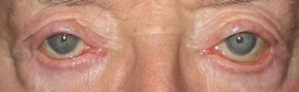 Ectropion | Eyelids turning outwards | Mr David Cheung | Eyelid ...