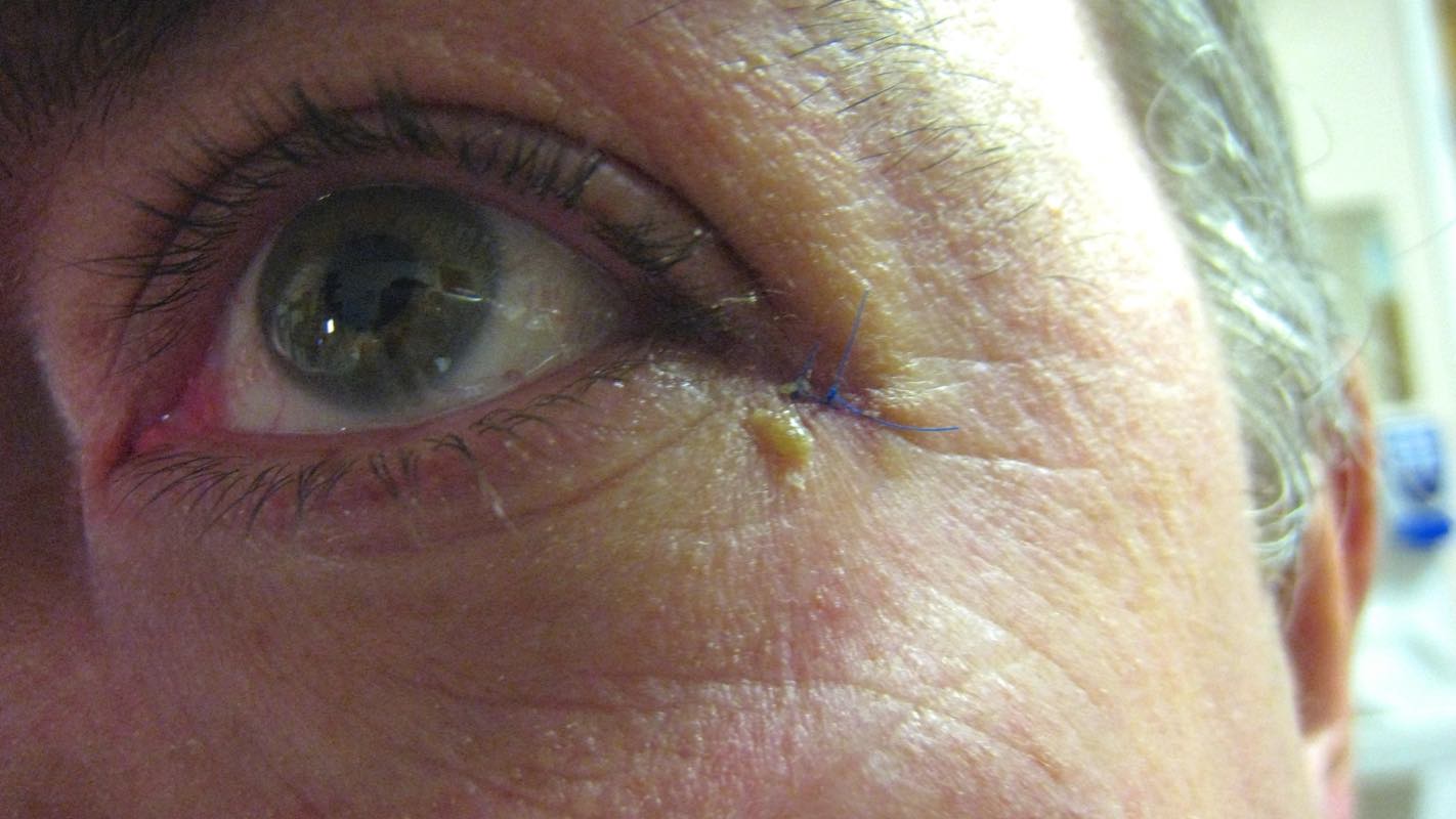 Treatment for lump inside eyelid, chalazion, eyelid cyst | Mr David ...