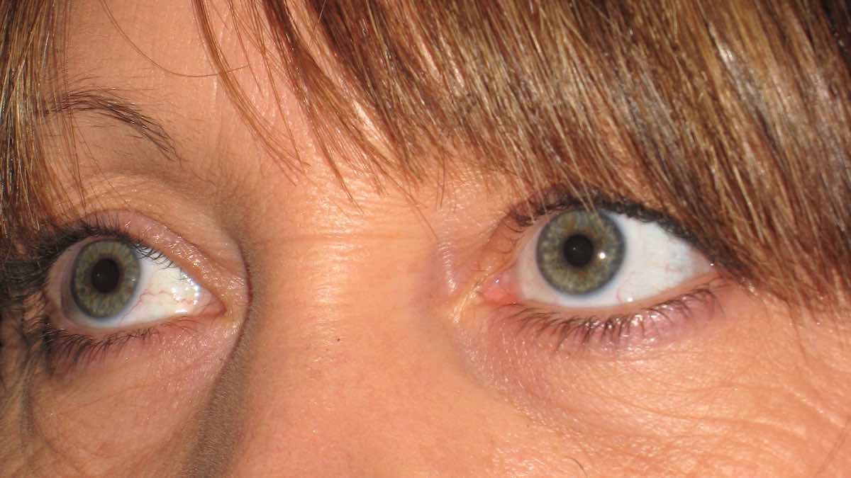 Watering Eyes | Watery Eyes | Blocked Tear Duct Surgery | Mr David ...